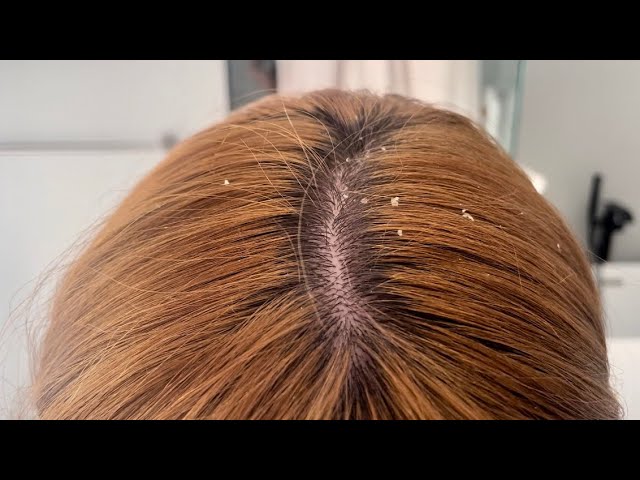 Peeling Scalp From Sunburn
