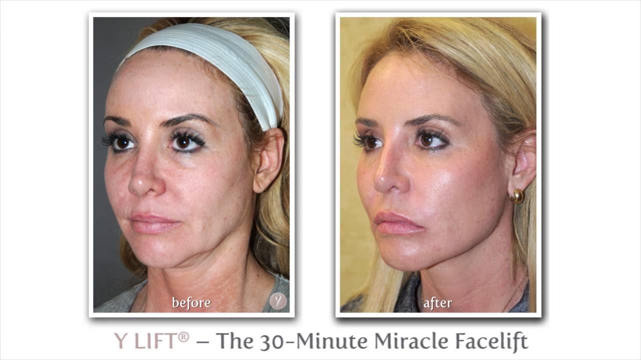 Y Lift Y LIFT Procedure In Brooklyn NY Non Surgical Facial