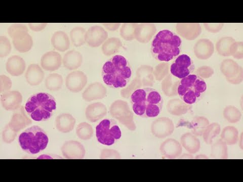 O QUE É ATLL (LEUCEMIA/LINFOMA DE CÉLULAS T DO ADULTO)? - YouTube