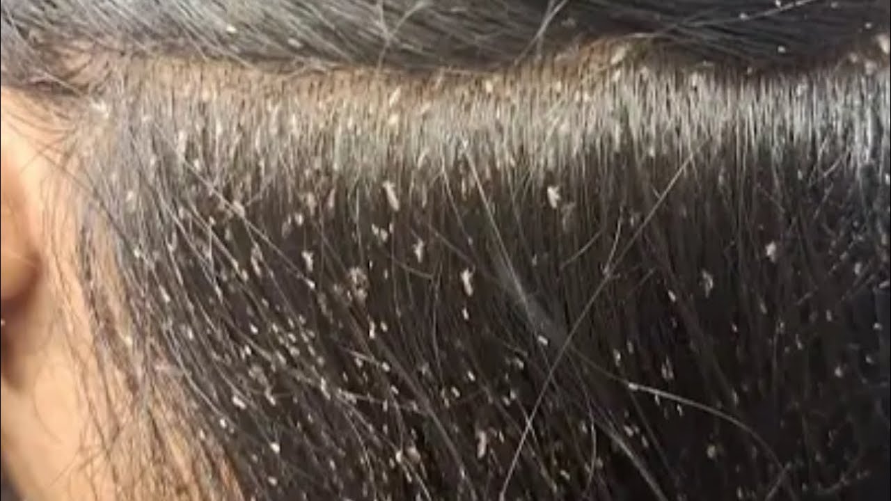 How to remove lice from head hair of infants | easy remove lice and ...