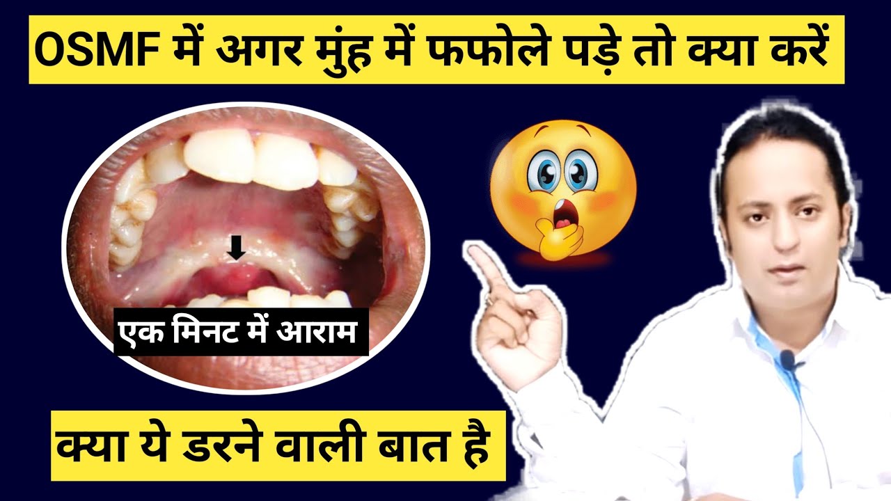 OSMF patient के मुंह में फफोले पड़े तो क्या करें, submucous fibrosis ...