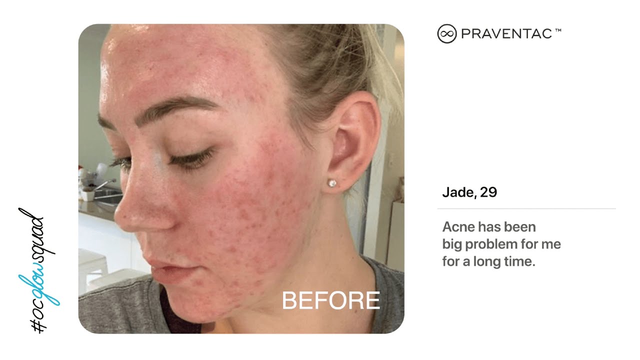 PRAVENTAC™ | The breakthrough solution for acne-proned skin - Onecare ...