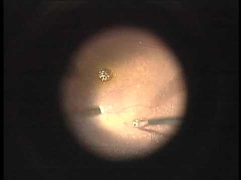 Modified inverted flap for macular hole - YouTube