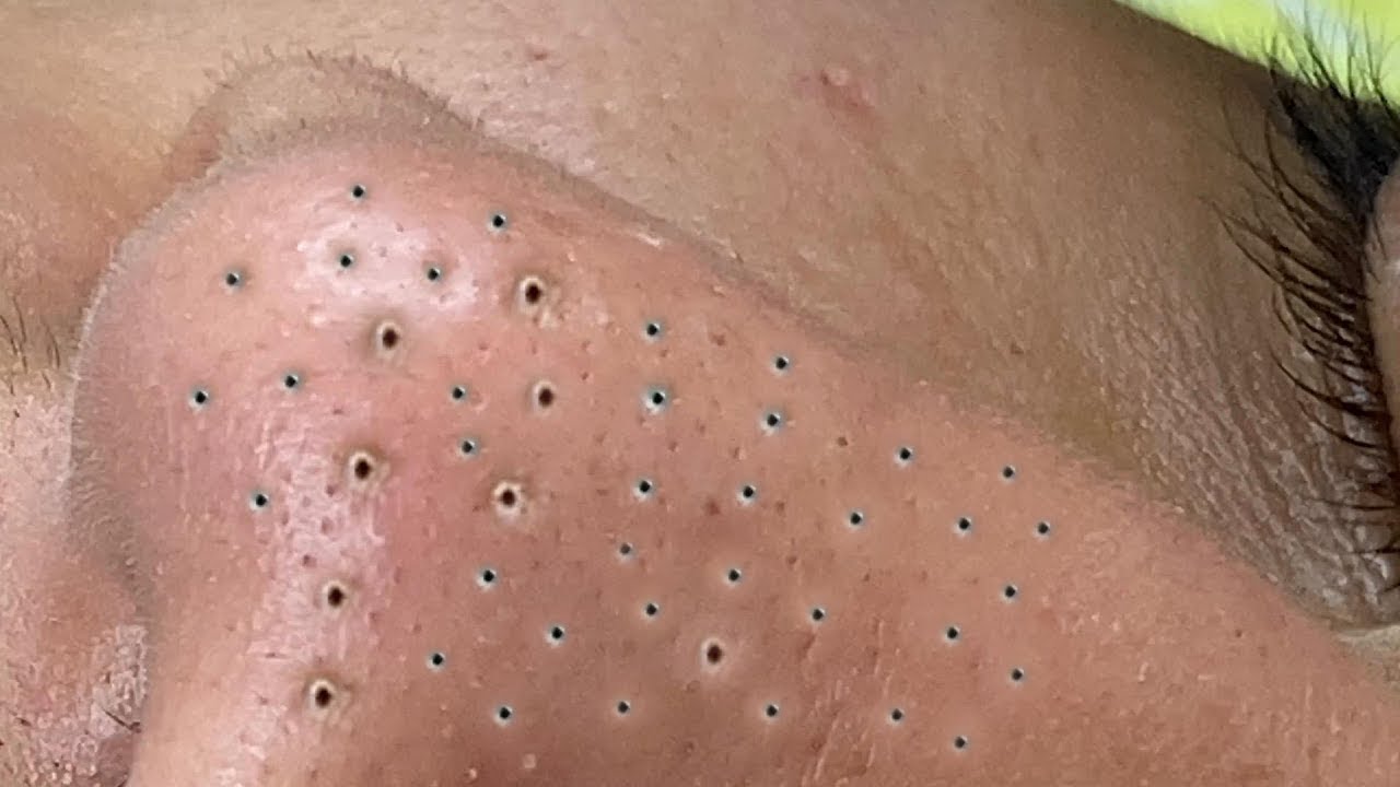 Big Cystic Acne Blackheads Extraction Blackheads & Milia, Whiteheads ...
