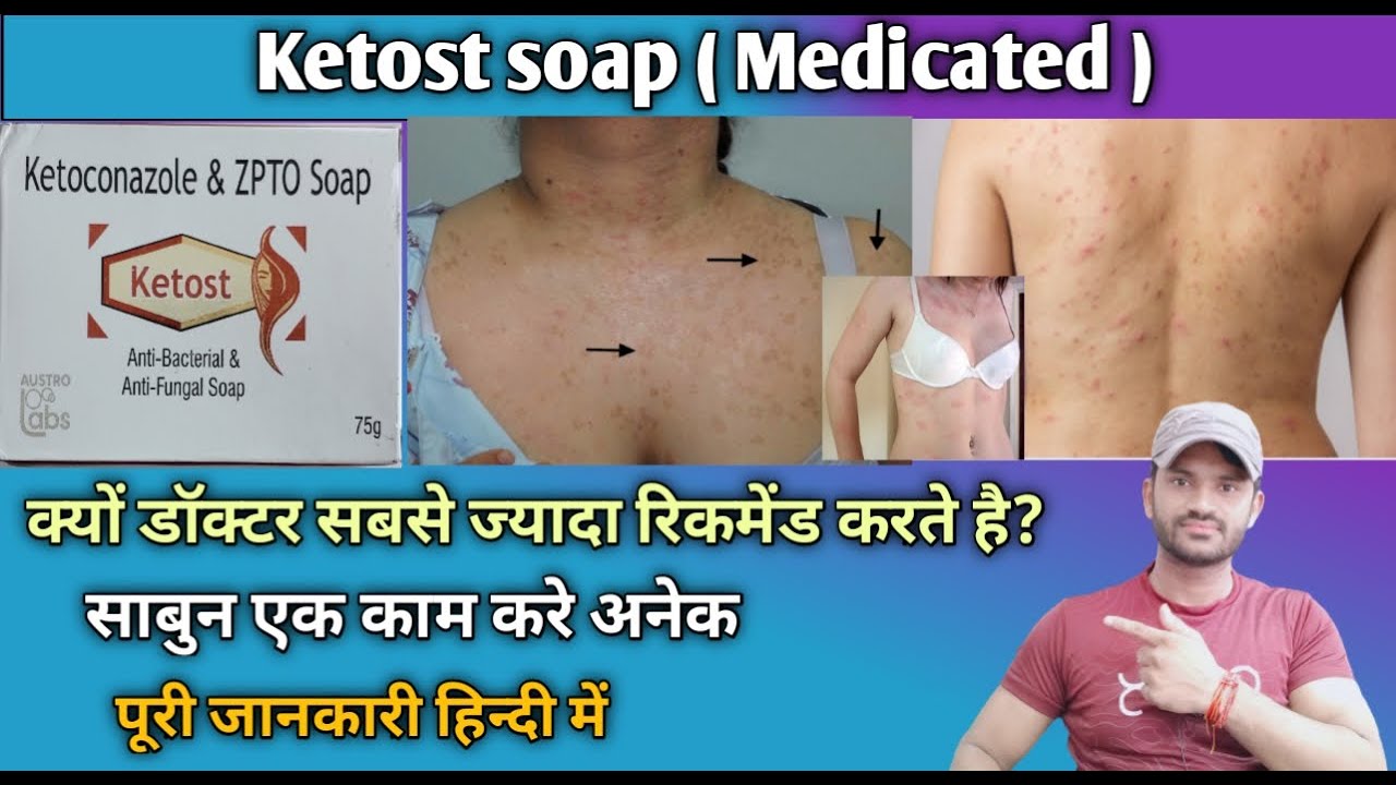 Ketost soap use benefits and Side effects full review in hindi - YouTube