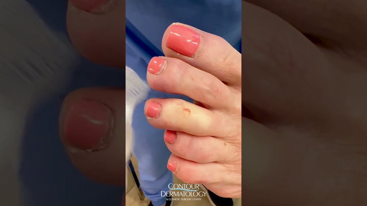 digital mucous cyst #shorts #dermatology - YouTube