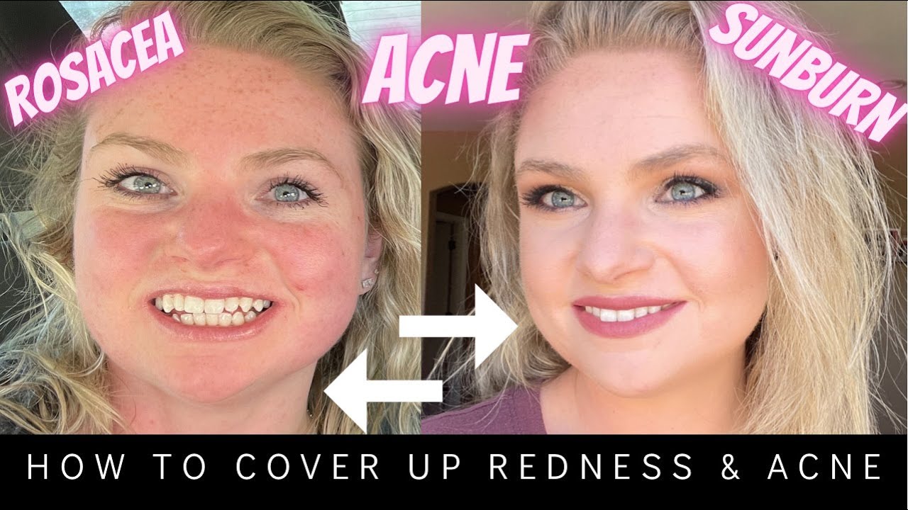 HOW TO COVER UP REDNESS AND ACNE WITH MAKEUP WHILE ON ACCUTANE how-to-cover-up-redness-and-acne-with-makeup-while-on-accutane