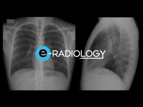 Cómo identificar las PROYECCIONES BÁSICAS de la RADIOGRAFÍA DE TÓRAX 🩻 ...