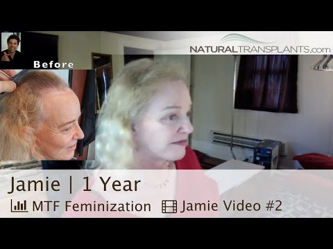 Male to Female Transgender Hair Transplant Surgery - 1 Year Later | Dr. Matt Huebner (Jamie)
