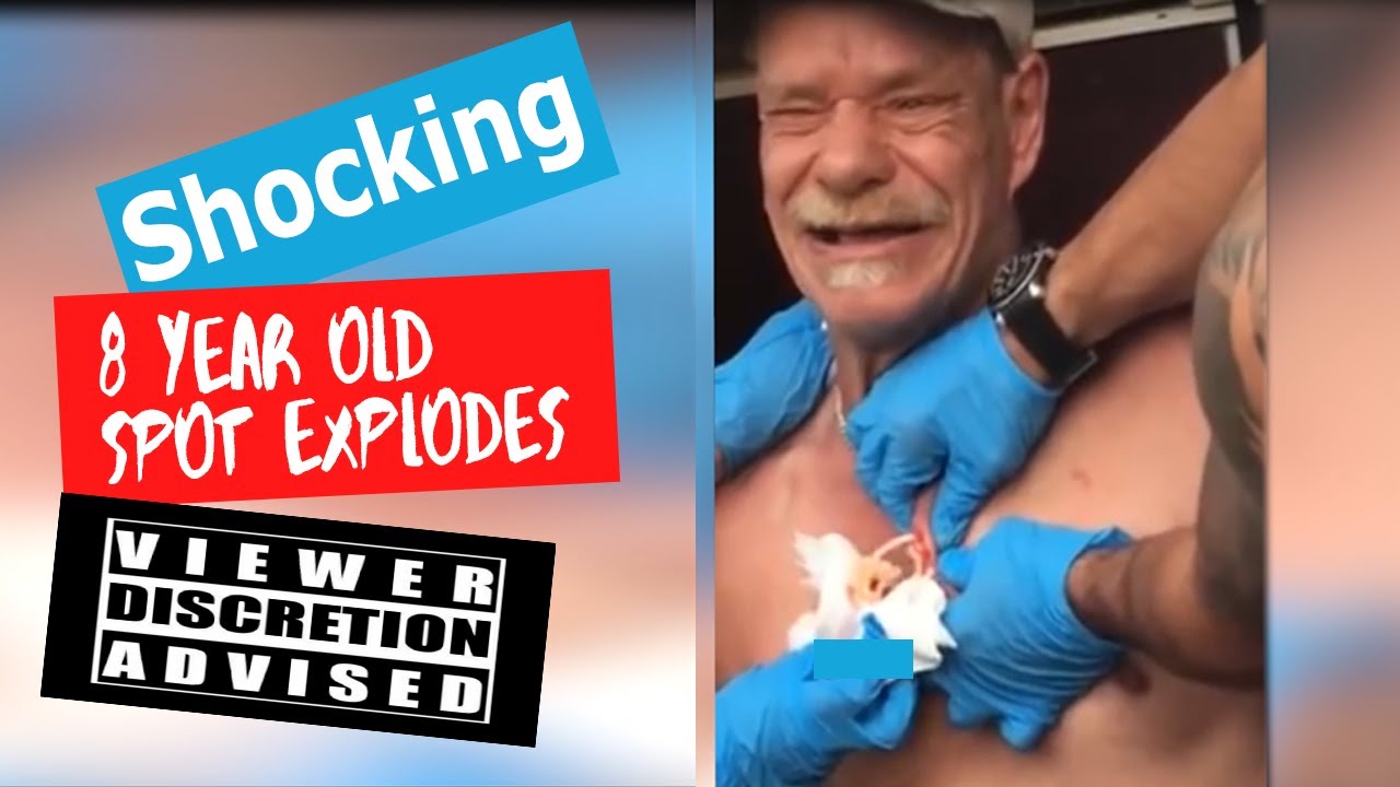 Shocking Backyard Pimple Popped - YouTube