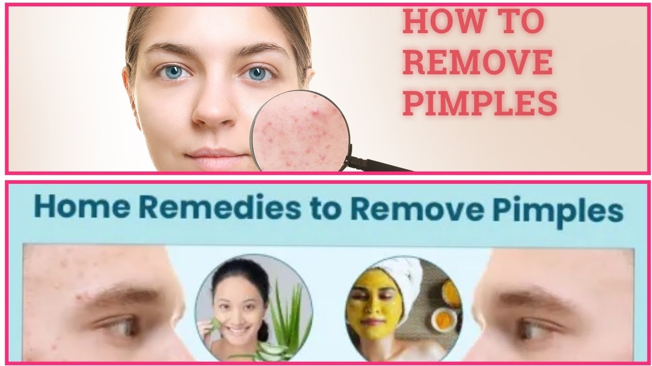 Home Remedies to Removed pimples | How to Remove Pimples | Health ...