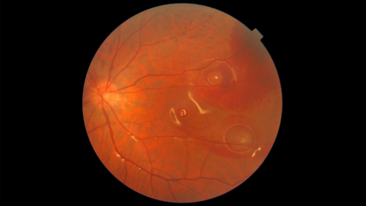 Aspiración de perfluorocarbono subretiniano - YouTube