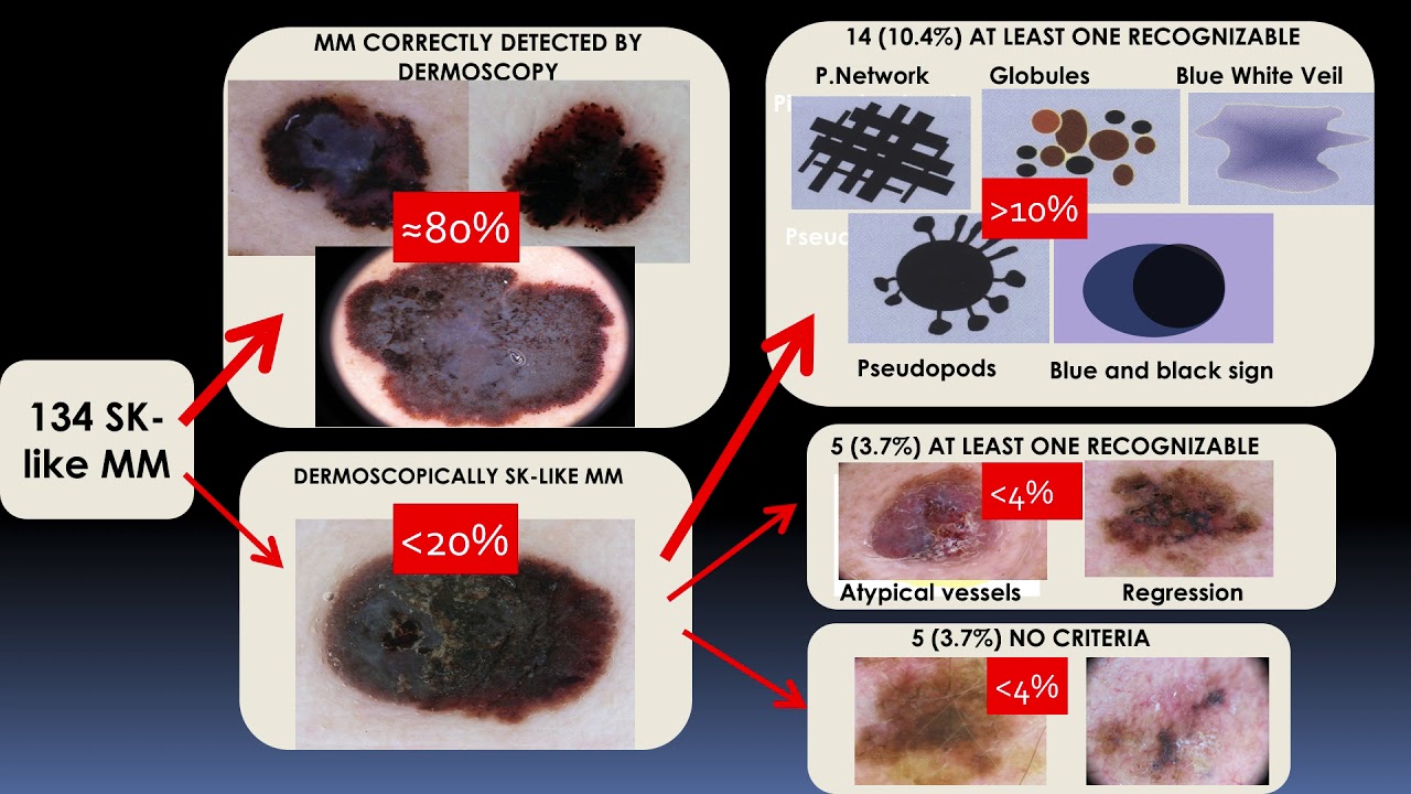 Seborrheic Keratosis-like melanomas - Dr. Cristina Carrera - YouTube