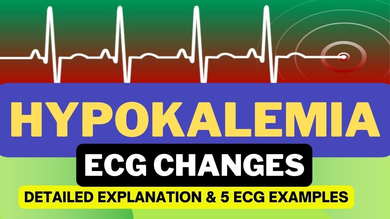ECG Changes in Hypokalemia | Hypokalemia ECG Changes | Detailed ...