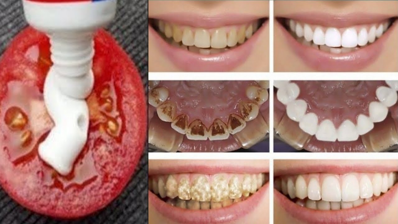 100% Effective | How to Naturally whitening your yellow Teeth | Teeth ...