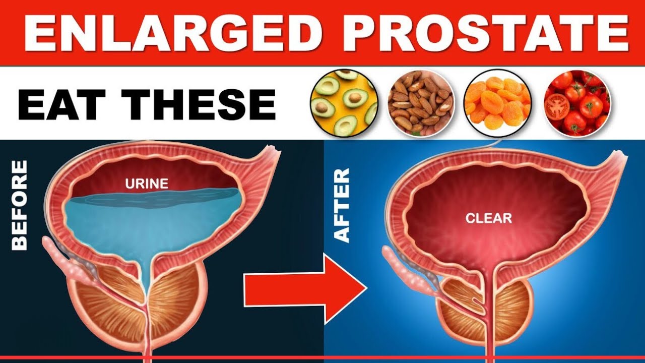 Prostate enlargement Treatment (Naturally) | Benign Prostatic ...