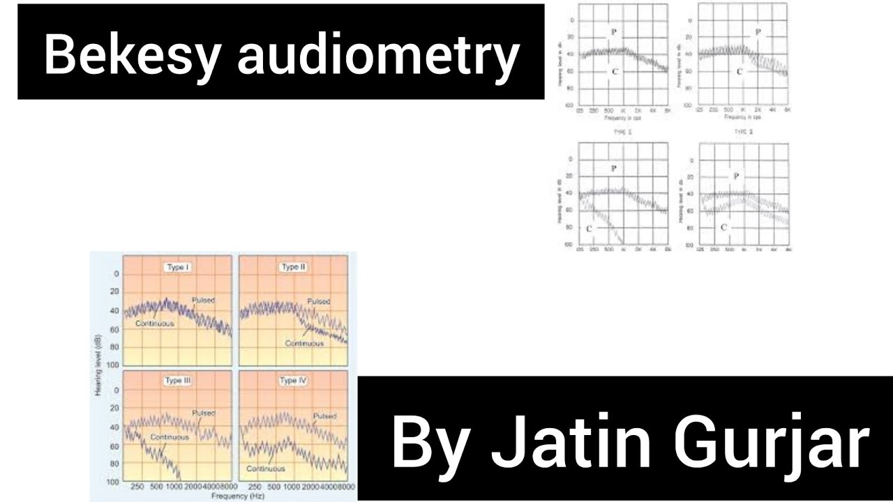 BEKESY audiometry , differential diagnosis of cp and rcp by bekesy ...