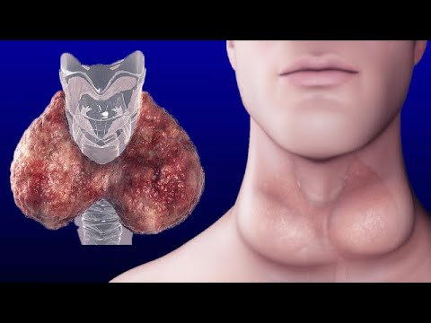 Swollen Legs & Constant Fatigue? How Thyroid Problems (Hypothyroidism) Cause Edema & Muscle Weakness