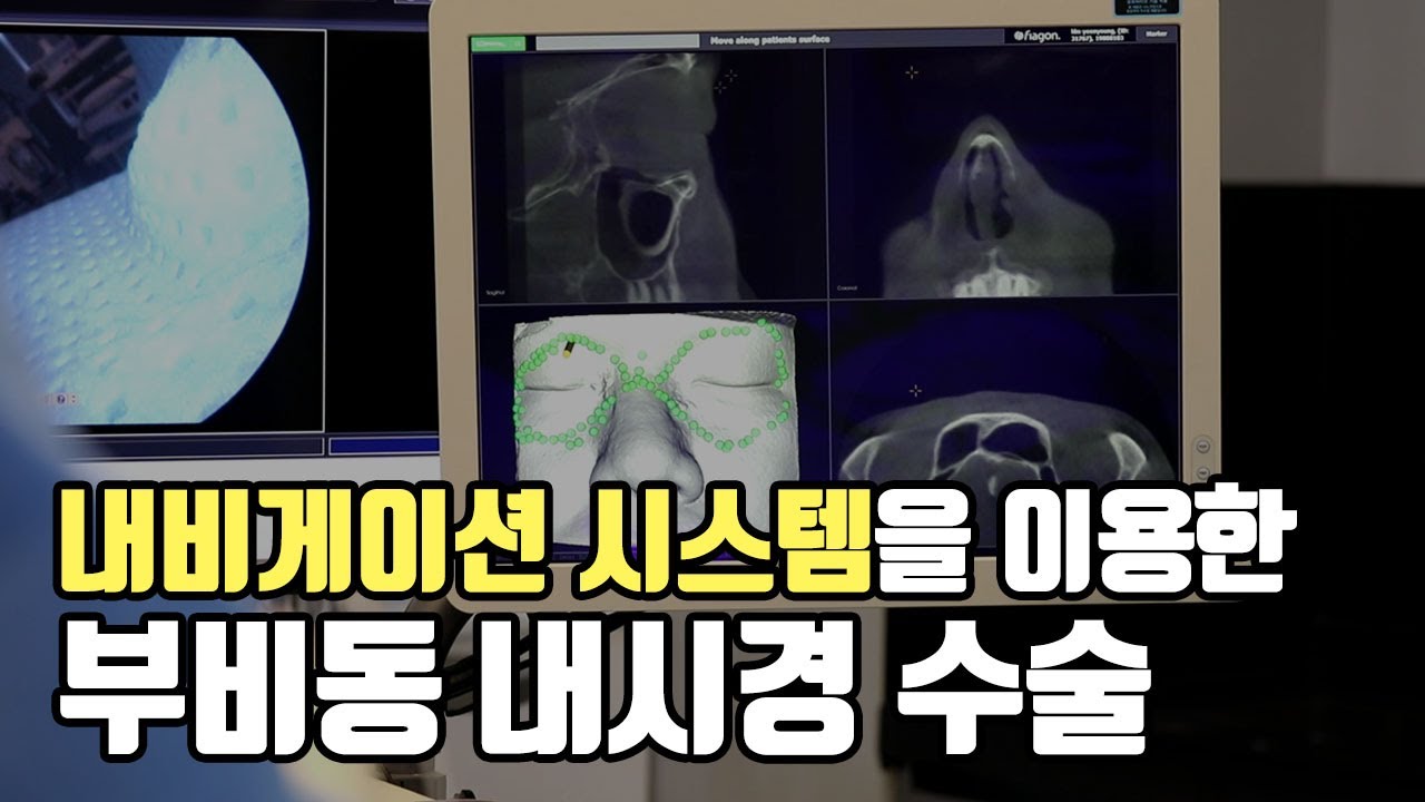 navigation guided ESS (endoscopic sinus surgery) - YouTube