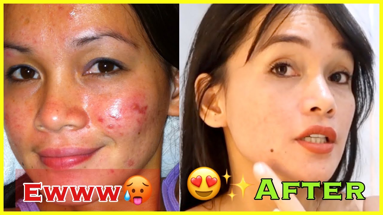 HOW I CLEARED MY ACNE? SKINCARE ROUTINE || PHILIPPINE DERMATOLOGIST ...