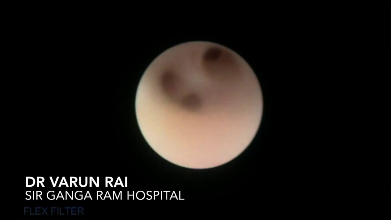 Parotid duct stenosis endoscopic management - Dr Varun Rai Delhi - YouTube