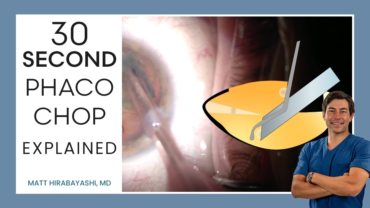 30 Second Phaco Chop Explanation - YouTube