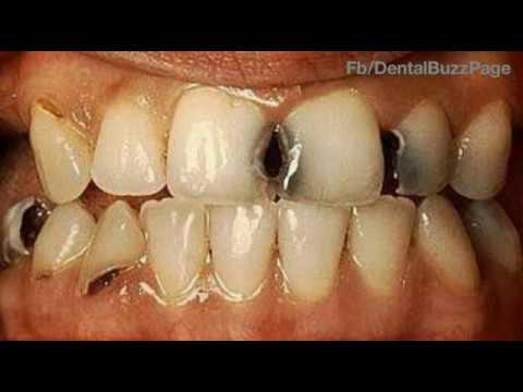 G.V. Black's Classification of Dental Caries - YouTube