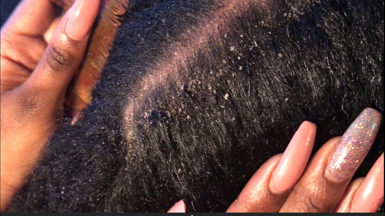 Lots of patches on mama PT 2| ASMR| Lice comb|🤙🏾 HD 1080p Quality - YouTube