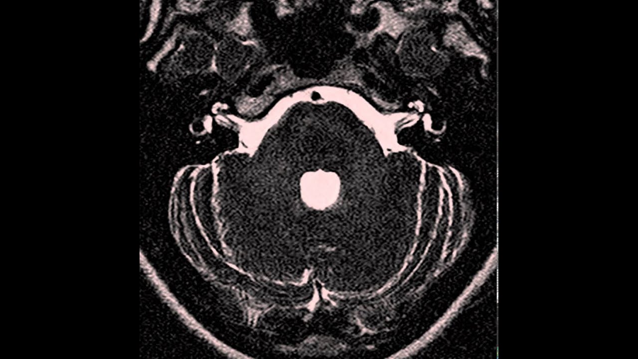 Magnetic Resonance of Brain, IAC - YouTube