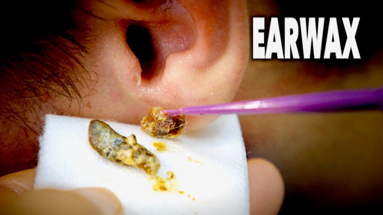 Large Ear Wax Plugs Extracted - YouTube