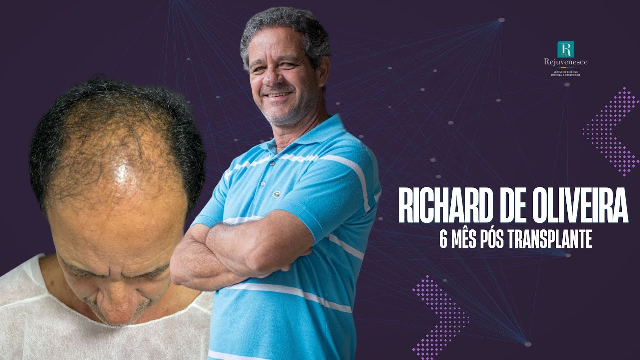 Transnplante Capilar - Somente 6 meses pós transplante do paciente Richard de Oliveira - YouTube