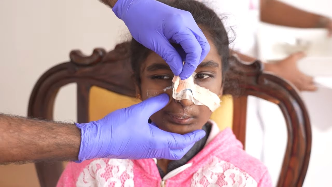 Nose & Scar Correction Rhinoplasty | Day 10 Splint Removal - YouTube