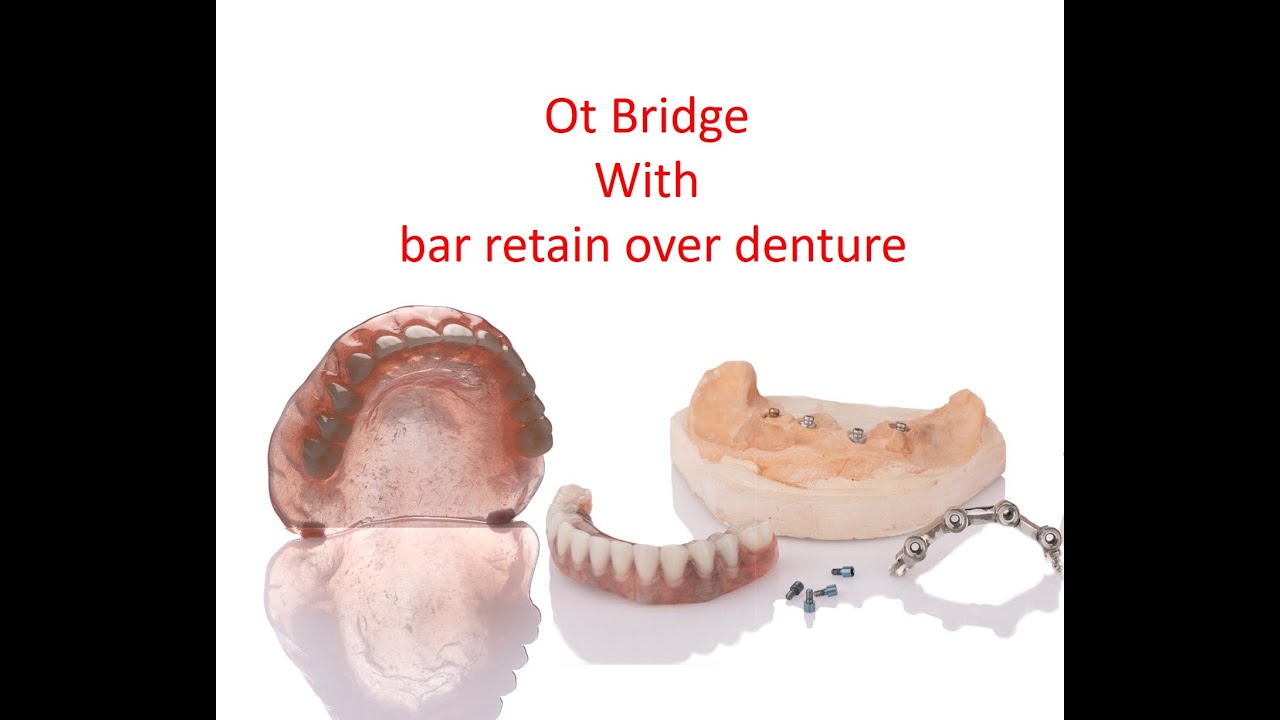 Ot Bridge with bar retain over denture - YouTube
