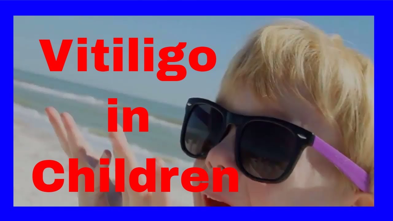 👭 Best Treatments for Vitiligo in Children 👭 - YouTube