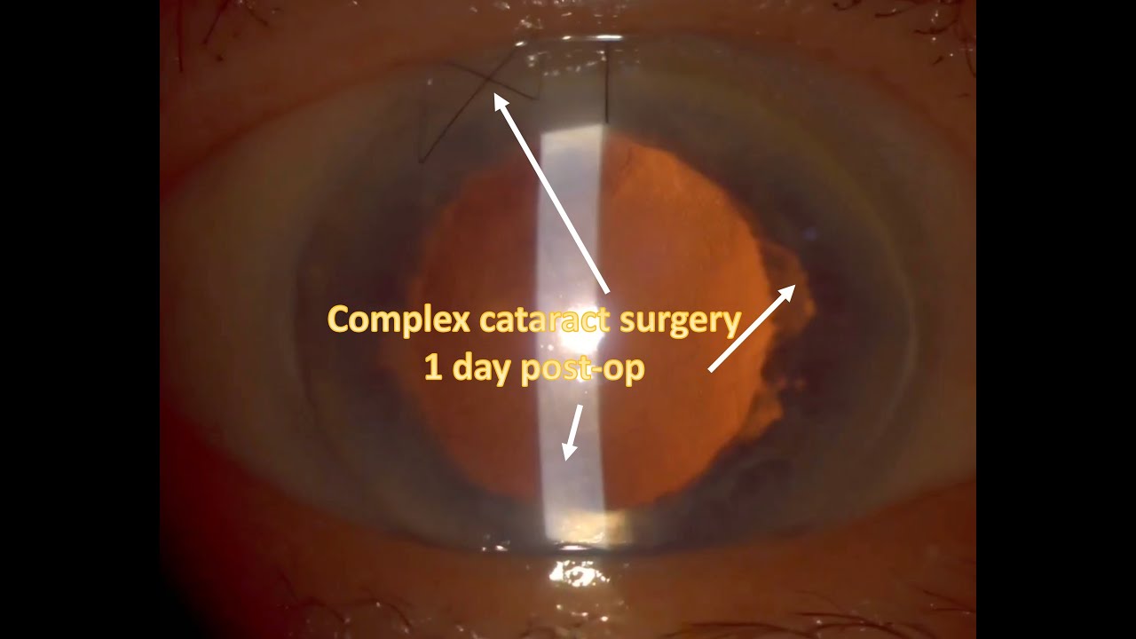 Complicated Cataract Surgery: The Aftermath - YouTube