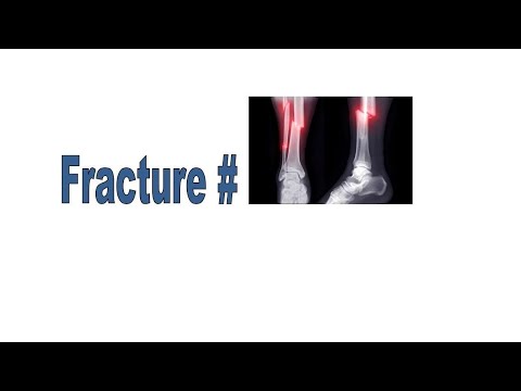 Fracture/Traction/Casts #nclex #nclexsuccess #nclexstudyguide - YouTube