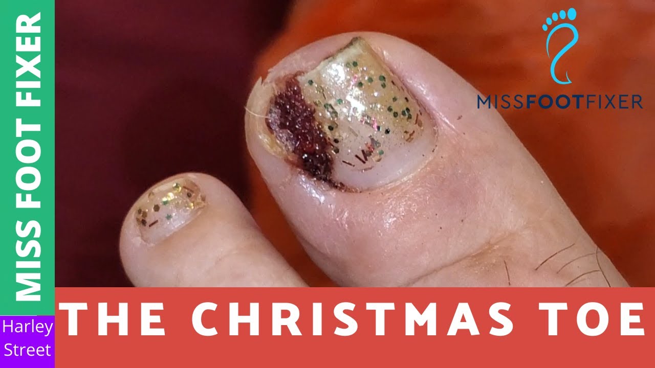 The Christmas Toe | Miss Foot Fixer | Marion Yau - YouTube