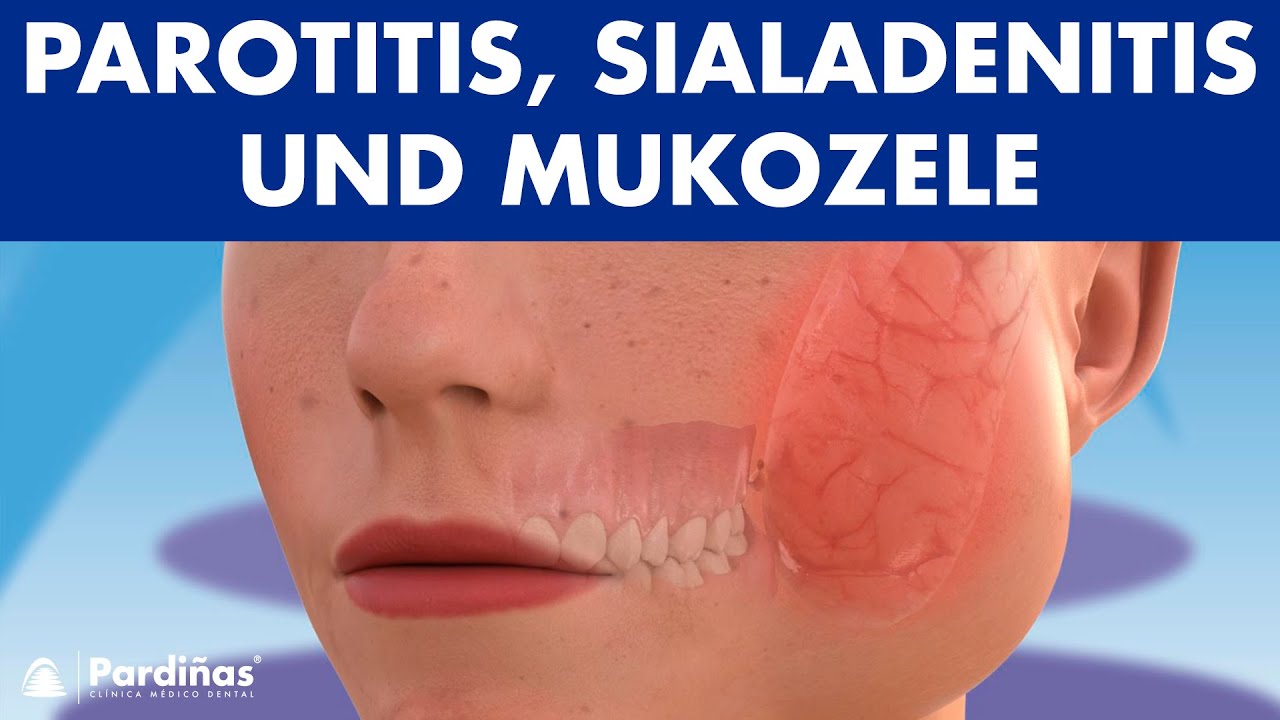 MUMPS (Parotitis) und andere Speicheldrüsenprobleme: Sialadenitis ...