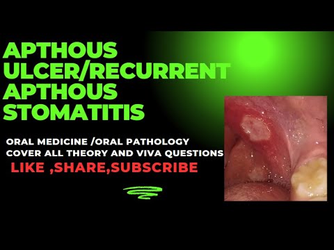 Apthous ulcer (apthous stomatitis)/canker sores ,introduction ,etiology ...