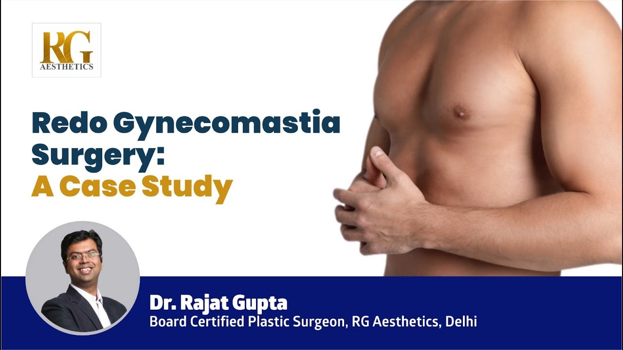 Redo Gynecomastia Surgery : A Case Study | Gynecomastia Scar | Dr Rajat ...