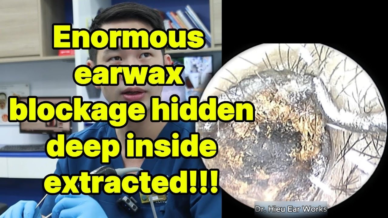 Enormous earwax blockage hidden deep inside extrac | ear cleaning ...