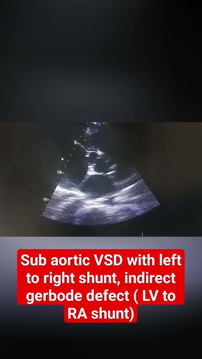 Sub Aortic Vsd With Left To Right Shunt Indirect Gerbode Defect Lv To Ra Shunt Youtube