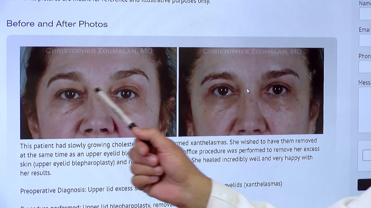 Benign Eyelid Lesions Beverly Hills - YouTube