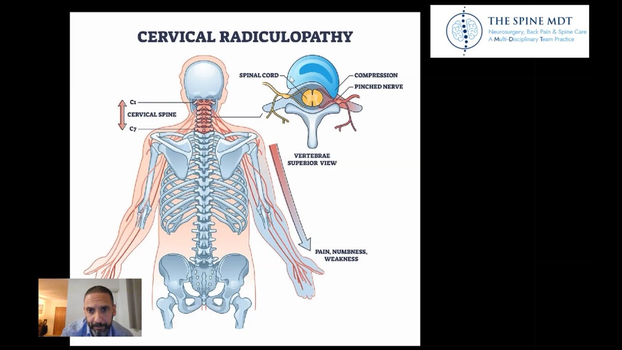 What is cervical radiculopathy? How to treat it? - YouTube