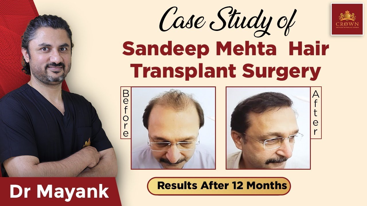 Case Study Actor Sandeep Mehta Hair Transplant Surgery | Celebrity Hair ...