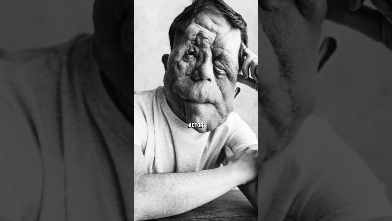 EL ACTOR CON NEUROFIBROMATOSIS QUE SE CONVIRTIO EN ESTRELLA DE ...