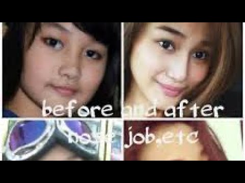 CHIENNA FILOMENO BEFORE AND AFTER PLASTIC SURGERY NAGPARETOKE NG ILONG ...