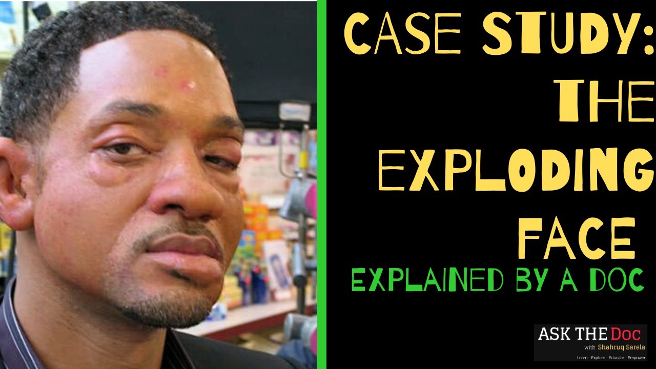 The Case of the Exploding Face - YouTube