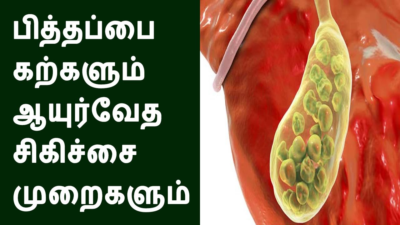 பித்தப்பை கற்கள் அறிகுறிகள் மற்றும் தீர்வுகள் | Gallstones ...