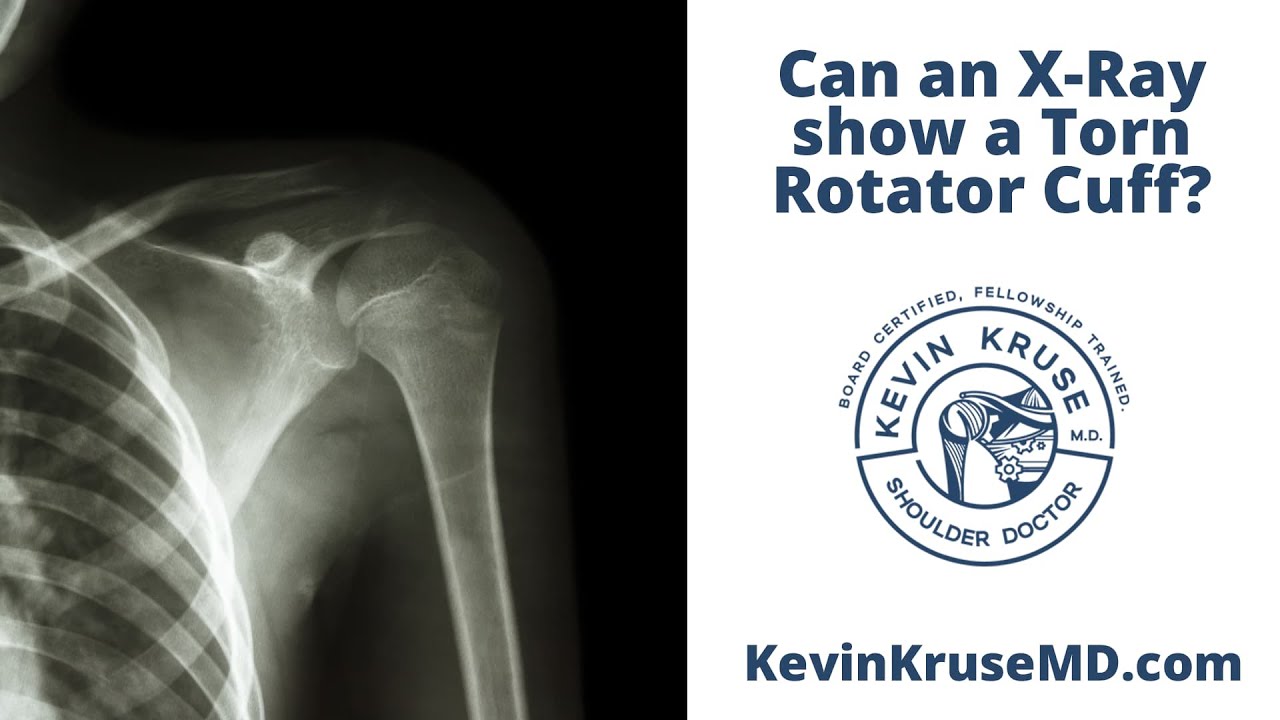 Can An X Ray Show A Torn Rotator Cuff YouTube Can An X Ray Show A Torn Rotator Cuff YouTube